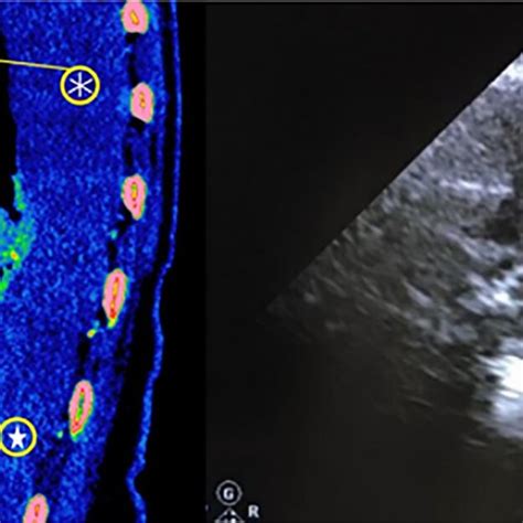 A Sagittal Reconstructed Contrast‐enhanced Computed Tomography