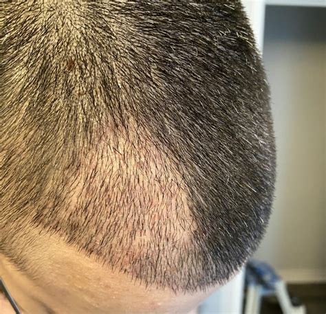 2 Weeks Post Hair Transplant R Hairtransplants
