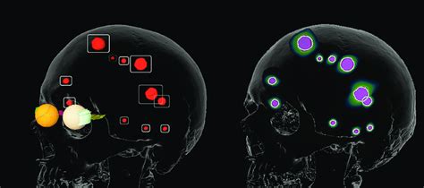 Figure Treatment Planning For Stereotactic Irradiation In A Patient Download Scientific