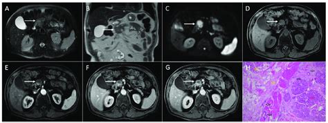 Pancreatic Adenocarcinoma In 43 Year Old Women Axial T2 Weighted Fs
