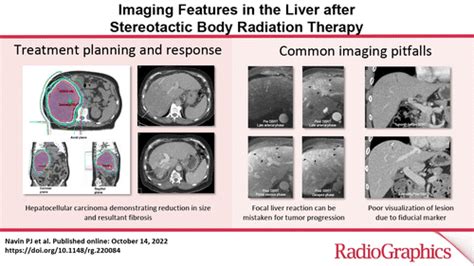 Imaging Features In The Liver After Stereotactic Body Radiation Therapy
