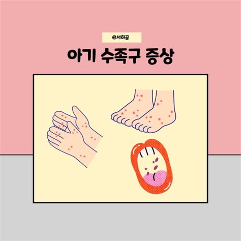 수족구 증상 아기 수족구 잠복기 목욕 격리 예방접종 네이버 블로그