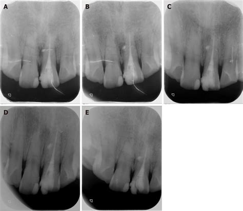 Periapical Radiographs A At Immediate Post Obturation B 1 Mo Download Scientific Diagram