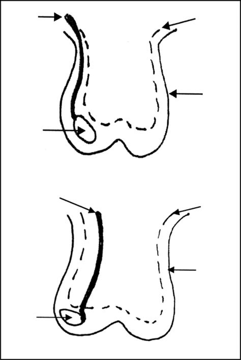Diagram Showing The Difference In The Course Of Spermatic Cord From Our