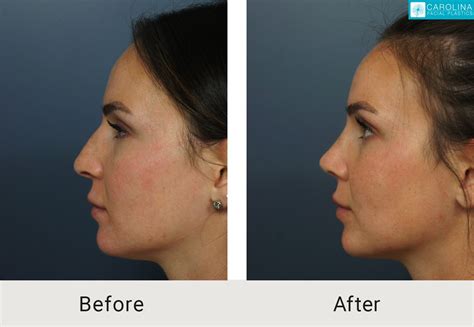 Rhinoplasty To Improve Nasal Bridge And Tip Carolina Facial Plastics