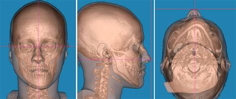 ¿en Qué Consiste La Cirugía Ortognática En La Especialidad Maxilofacial