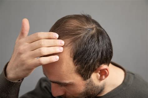 Premium Photo Caucasian Man Hair Loss Problem
