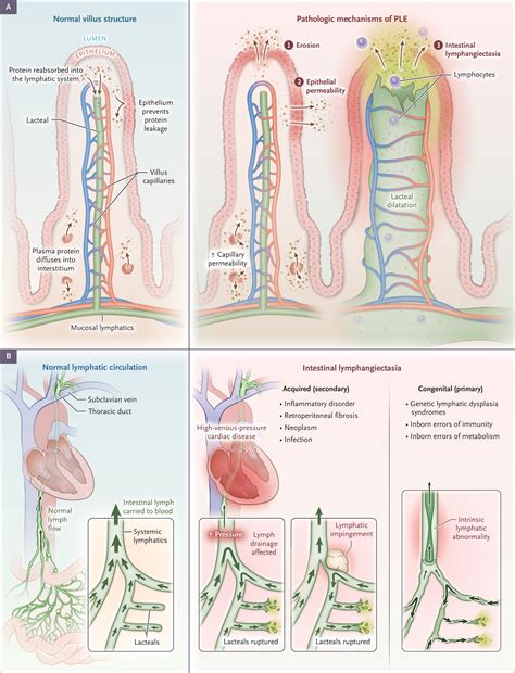 Protein Losing Enteropathy Nejm