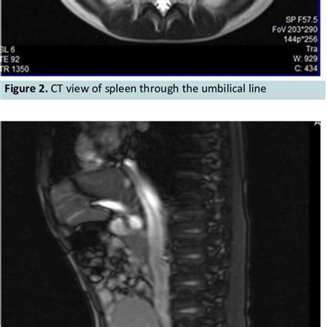 Sagittal CT Of Abdomen Download Scientific Diagram