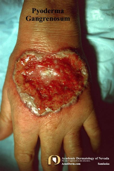 Pyoderma Gangrenosum Its Not An Infection Academic Dermatology Of Nevada
