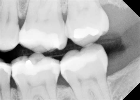 Hot Sensitivity After Restorations Spear Talk
