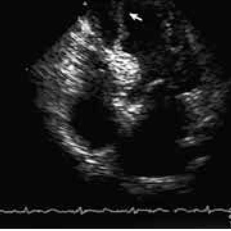 Apical 4 Chamber View Opacification Of The Left Ventricular Cavity By