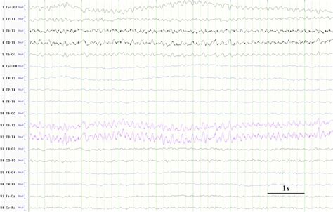 Electroencephalogram EEG At The Time Of Recurrence Download Scientific Diagram