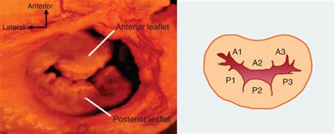 Congenital Anomalies Of The Mitral Valve Thoracic Key
