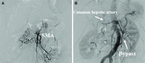 Superior Mesenteric Artery Sma And Aorta Angiography After The