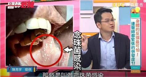 嘴巴痛刷牙也沒用一張開「佈滿白點」念珠菌感染 醫愣：糖尿病 生活 Ctwant