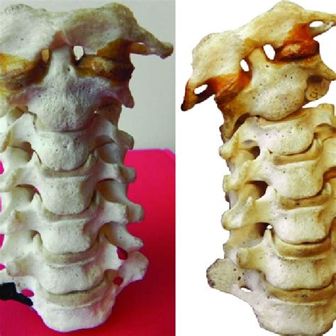 Pdf Analysis Of The Uncinate Processes Of The Cervical Spine An