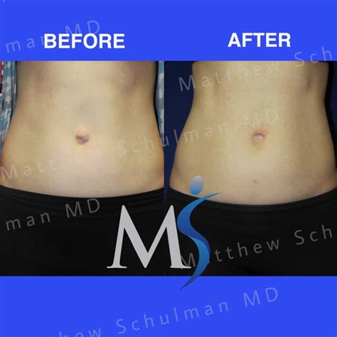 Belly Button Surgery Photos Matthew Schulman Md
