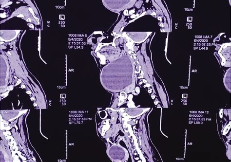 An Unusual Presentation Of Large Colloid Goiter A Case Report Adesh