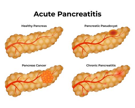Premium Vector Acute Pancreatitis Healthy Pancreas Cancer Pancreatic