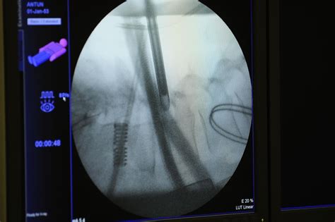 Selective Endoscopic Discectomy Sed