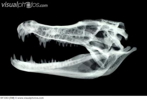 Pirogoff Amputation Buyxraysonline