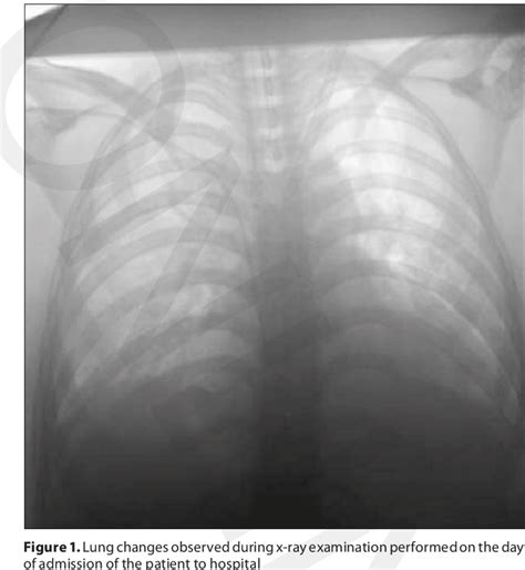 Figure 1 From Acinetobacter Baumannii Ventilator Associated Pneumonia