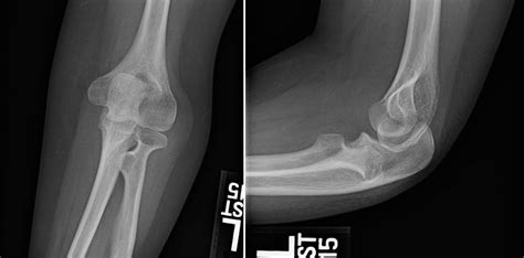 Congenital Radial Head Dislocation Hand Orthobullets