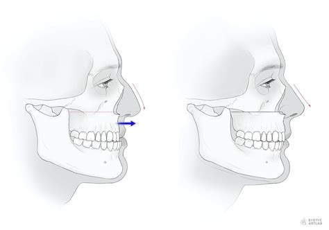 Maxillary Osteotomy Medical Illustrations — Biotic Artlab