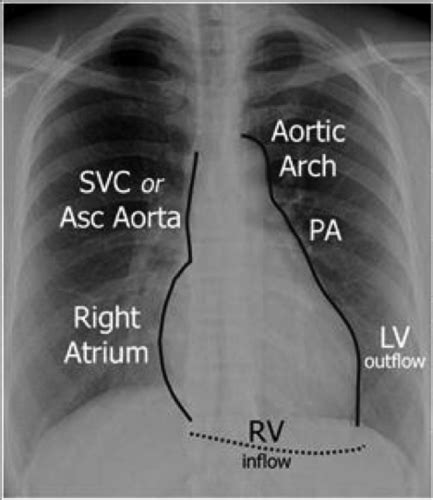 Cardiovascular Radiology Flashcards Quizlet