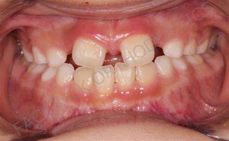 授乳中・妊娠中の矯正歯科治療について 医療法人社団 Face And Smile フェイストーク麻布十番矯正歯科 矯正歯科専門クリニック