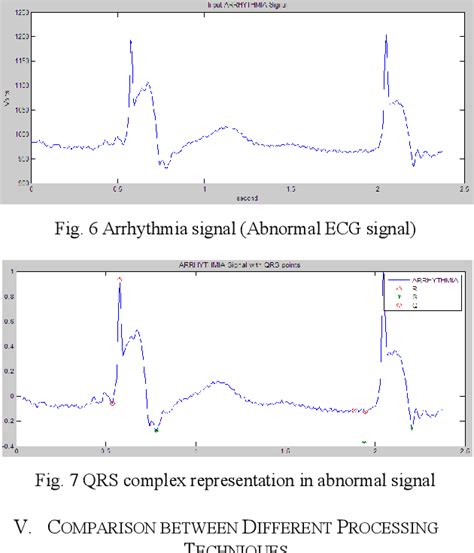 Figure 1 From Analysis Of Electrocardiograph Ecg Signal For The Detection Of Abnormalities