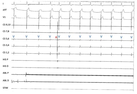 Electrogram Interpretation 18 Ep Essentials