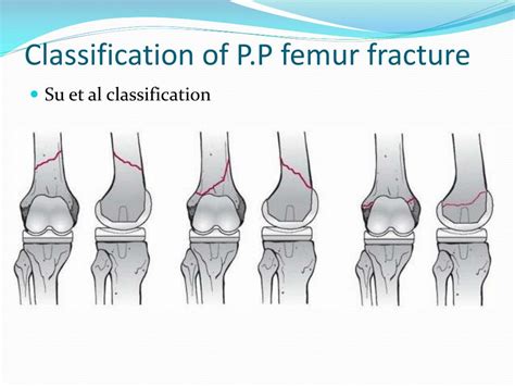 Ppt Periprosthetic Fractures Powerpoint Presentation Free Download Id5807855
