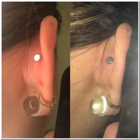 Cyst Earlobe