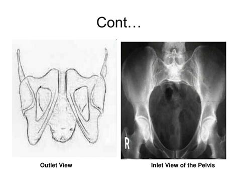 Ppt Pelvis Fracture Powerpoint Presentation Free Download Id737949