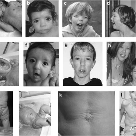 PDF Autosomal Recessive Cutis Laxa Syndrome Revisited