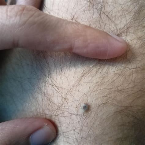 Weird Black Bump On Thigh Rmedical
