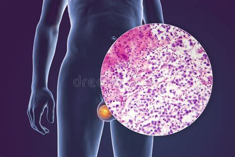 Testicular Cancer Testicular Seminoma Medical 3d Illustration And