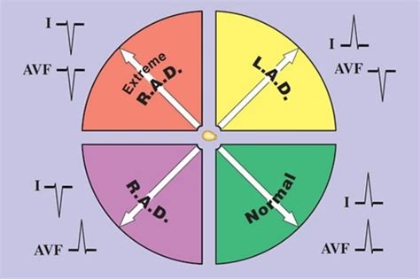 Ekg 6 Axis Flashcards Quizlet