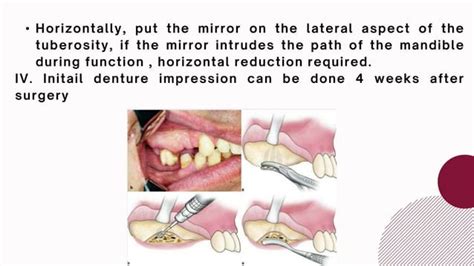 Pre Prosthetic Surgery Pptx Pptx Surgery Medical Health
