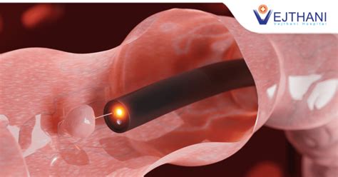 Colon Cancer Treatment In Thailand Consists Of Four Stages Life