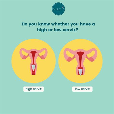 High Vs Low Cervix