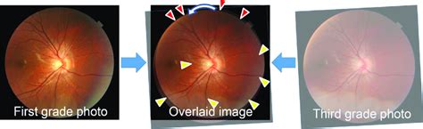 Assessment Of The Retinal Vessel Shift Using Fundus Photographs Of The Download Scientific