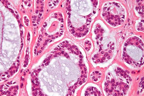 Adenoid Cystic Carcinoma Of Gums