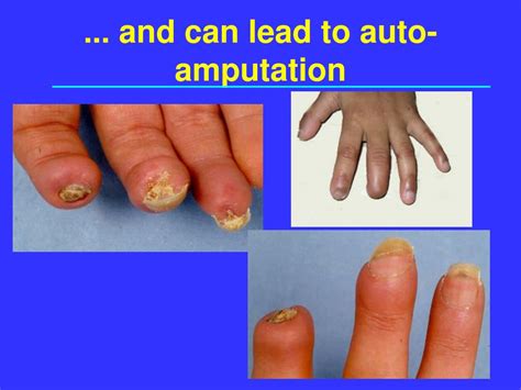 Ppt Scleroderma Powerpoint Presentation Free Download Id2762083