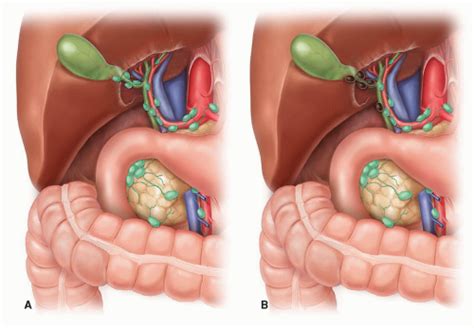 Gallbladder Cancer Abdominal Key