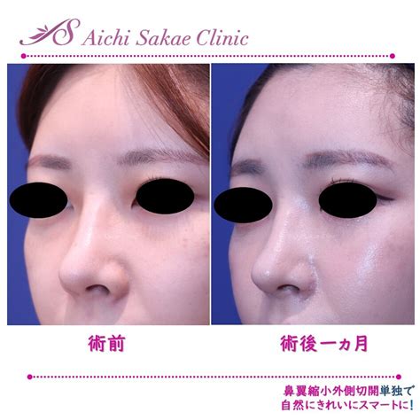 鼻の手術はあいち栄クリニックへ！ 鼻の整形の症例写真・画像 あいち栄クリニック Cs48418 《美容医療の口コミ広場》