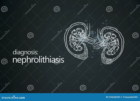 Nefrolitiasis Cálculos Renales Enfermedad O Urolitiasis Cálculo Renal