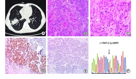 Radiological And Histological Features And Discoidin Domain Containing Download Scientific